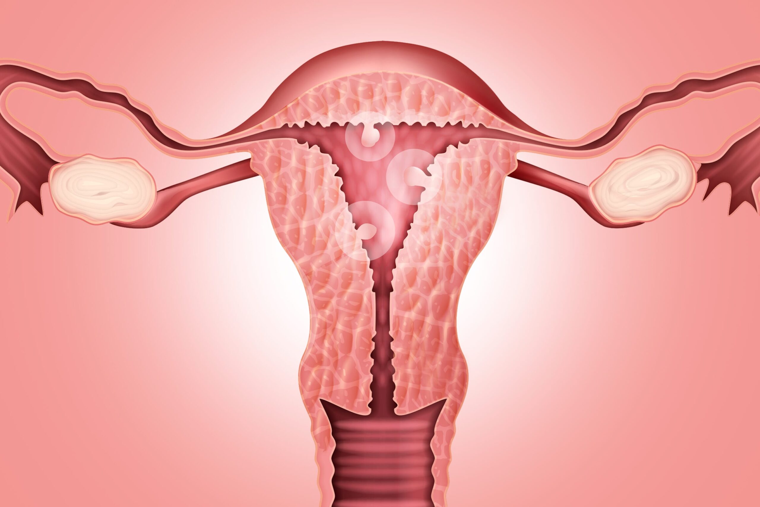 Pólipos – Dr. Mario Ramin